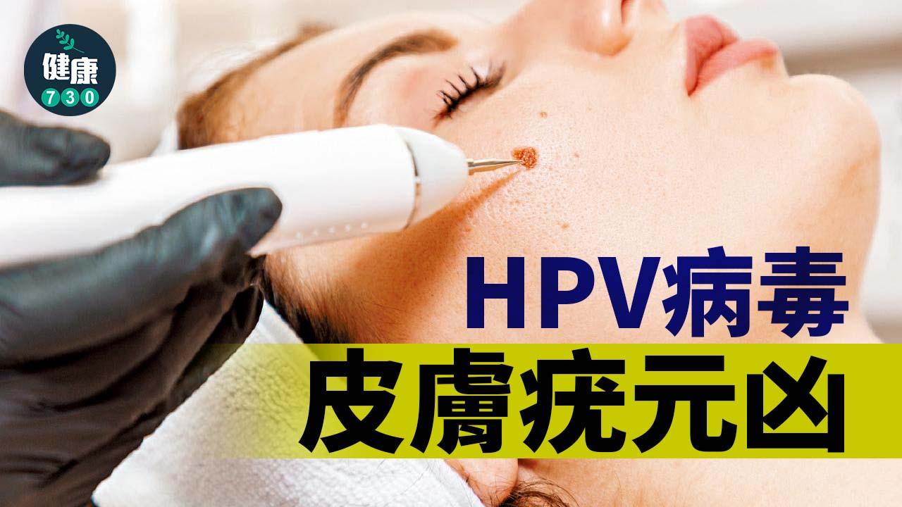 皮膚病｜HPV病毒 皮膚疣元凶 | am730
